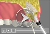 Dental Implant Apex, Implant Dentistry in Apex and Cary NC